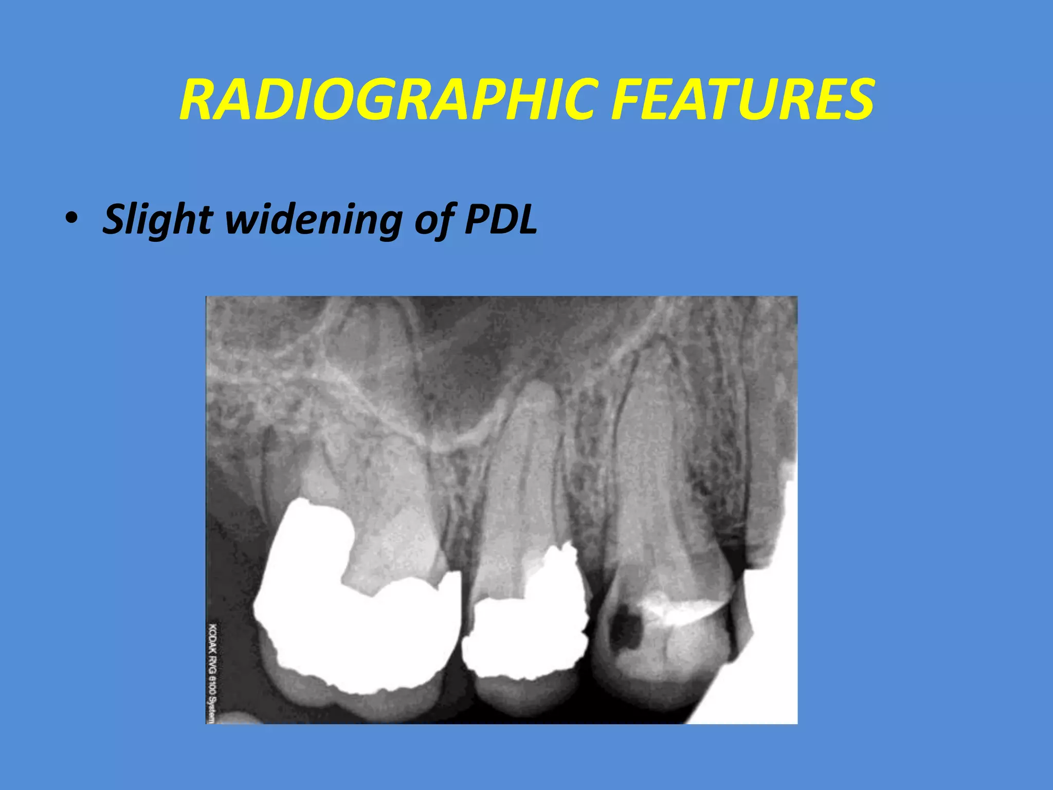 DIFFERENTIAL DIAGNOSIS FOR PERIAPICAL RADIOLUCENCY.pptx