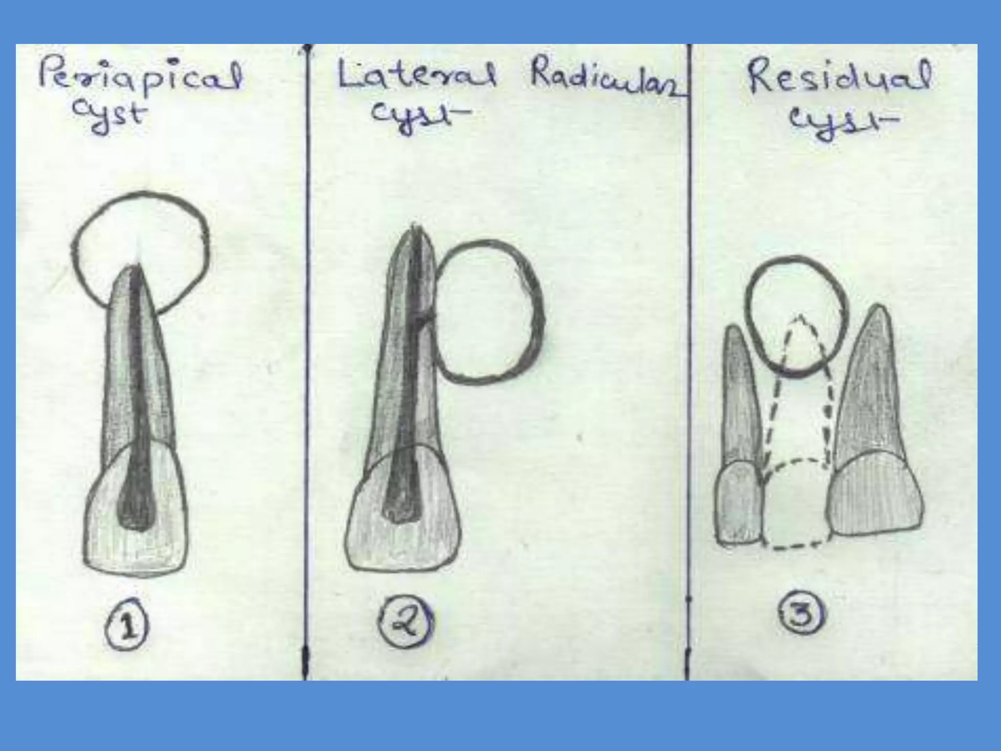 DIFFERENTIAL DIAGNOSIS FOR PERIAPICAL RADIOLUCENCY.pptx