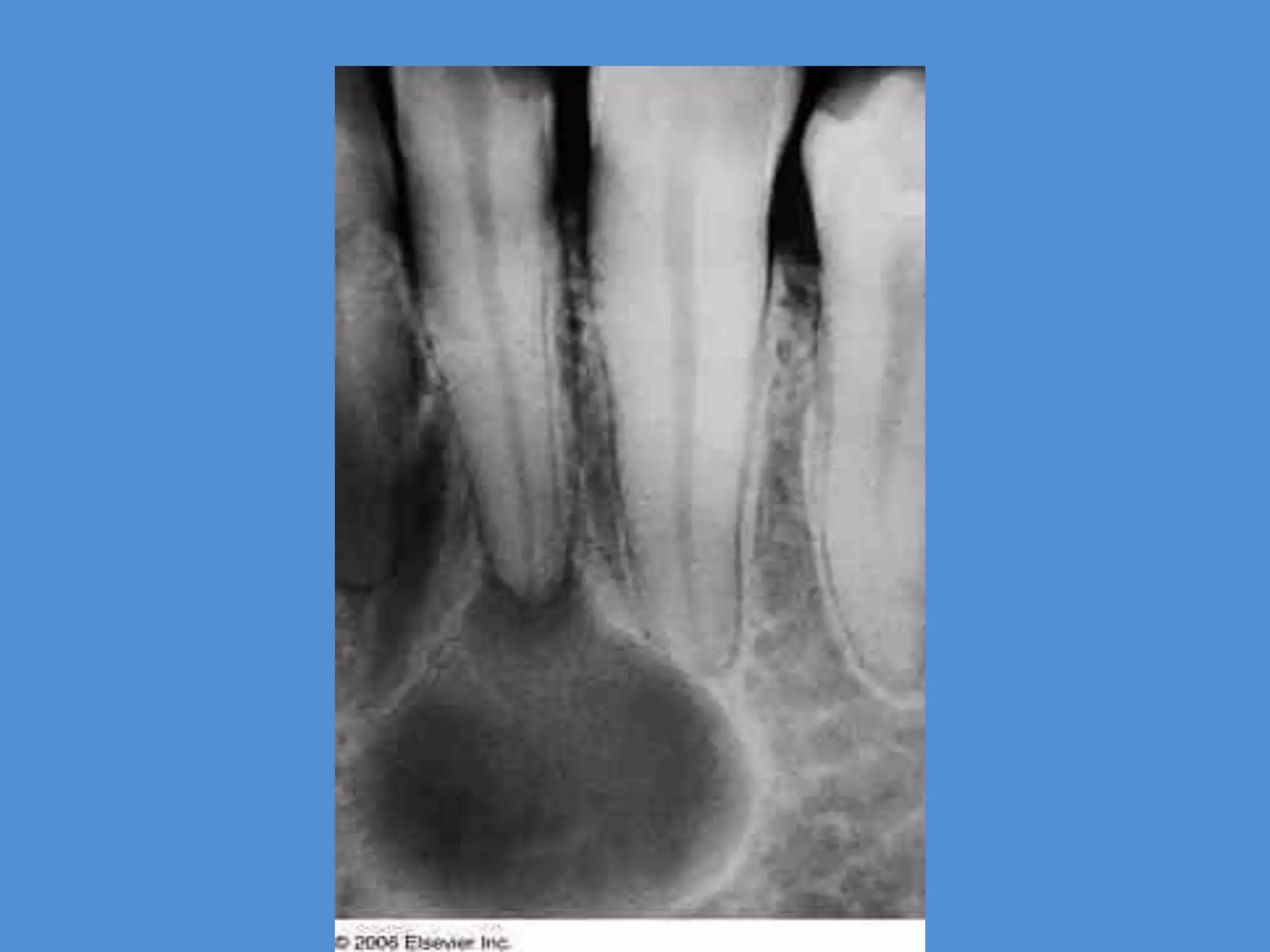 DIFFERENTIAL DIAGNOSIS FOR PERIAPICAL RADIOLUCENCY.pptx