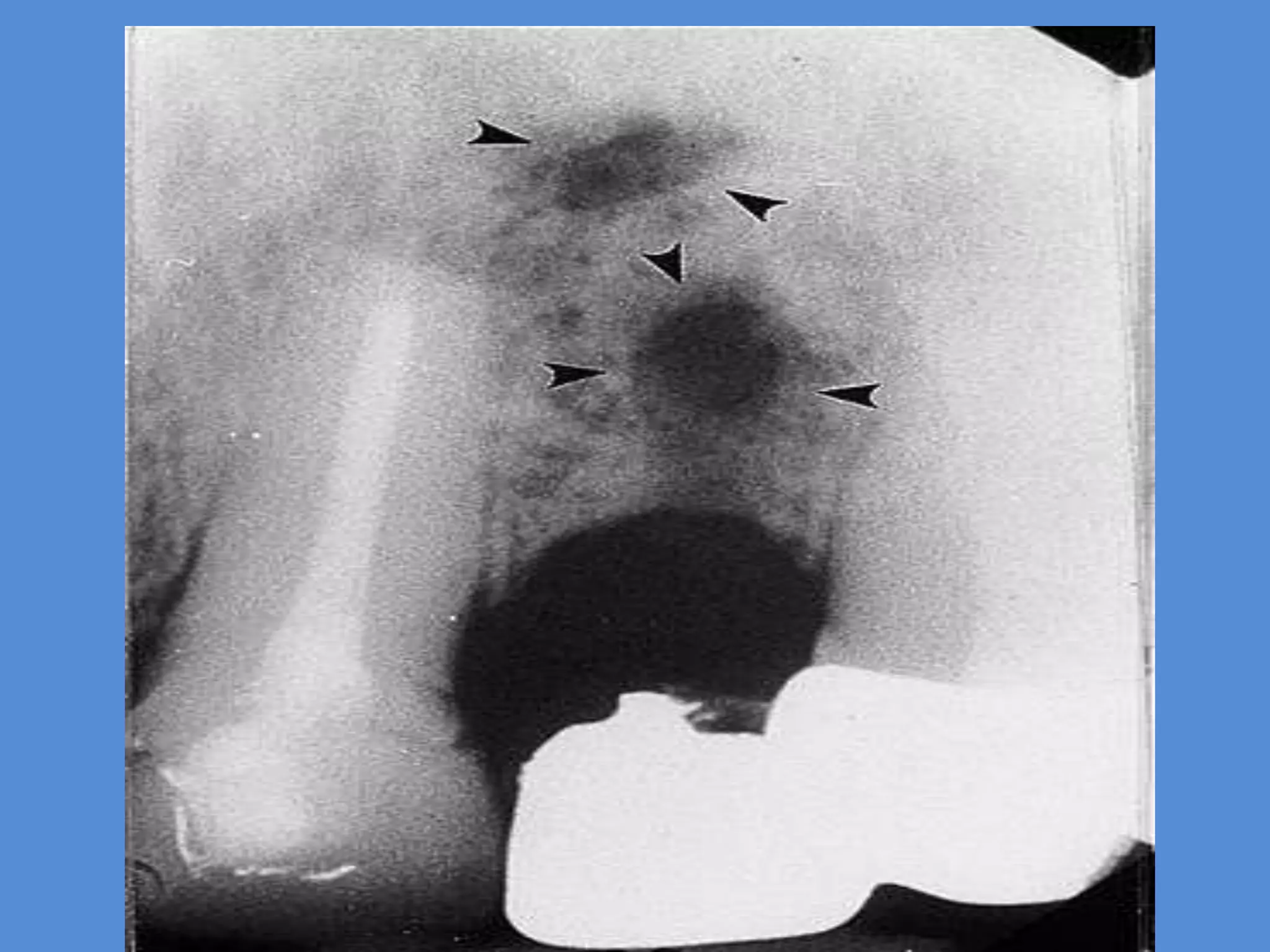 DIFFERENTIAL DIAGNOSIS FOR PERIAPICAL RADIOLUCENCY.pptx