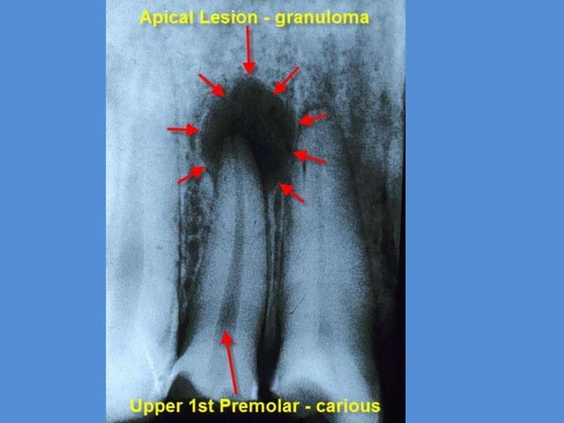 DIFFERENTIAL DIAGNOSIS FOR PERIAPICAL RADIOLUCENCY.pptx