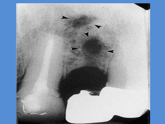 DIFFERENTIAL DIAGNOSIS FOR PERIAPICAL RADIOLUCENCY.pptx
