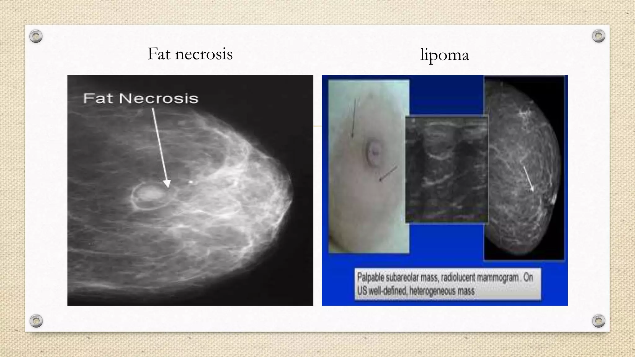 Differential diagnosis of breast mass; pathology - March 2016 | PPTX