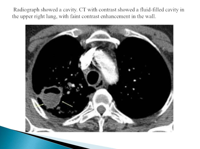 Differential diagnosis of cavitary lung lesions