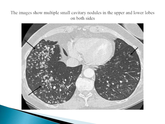Differential diagnosis of cavitary lung lesions