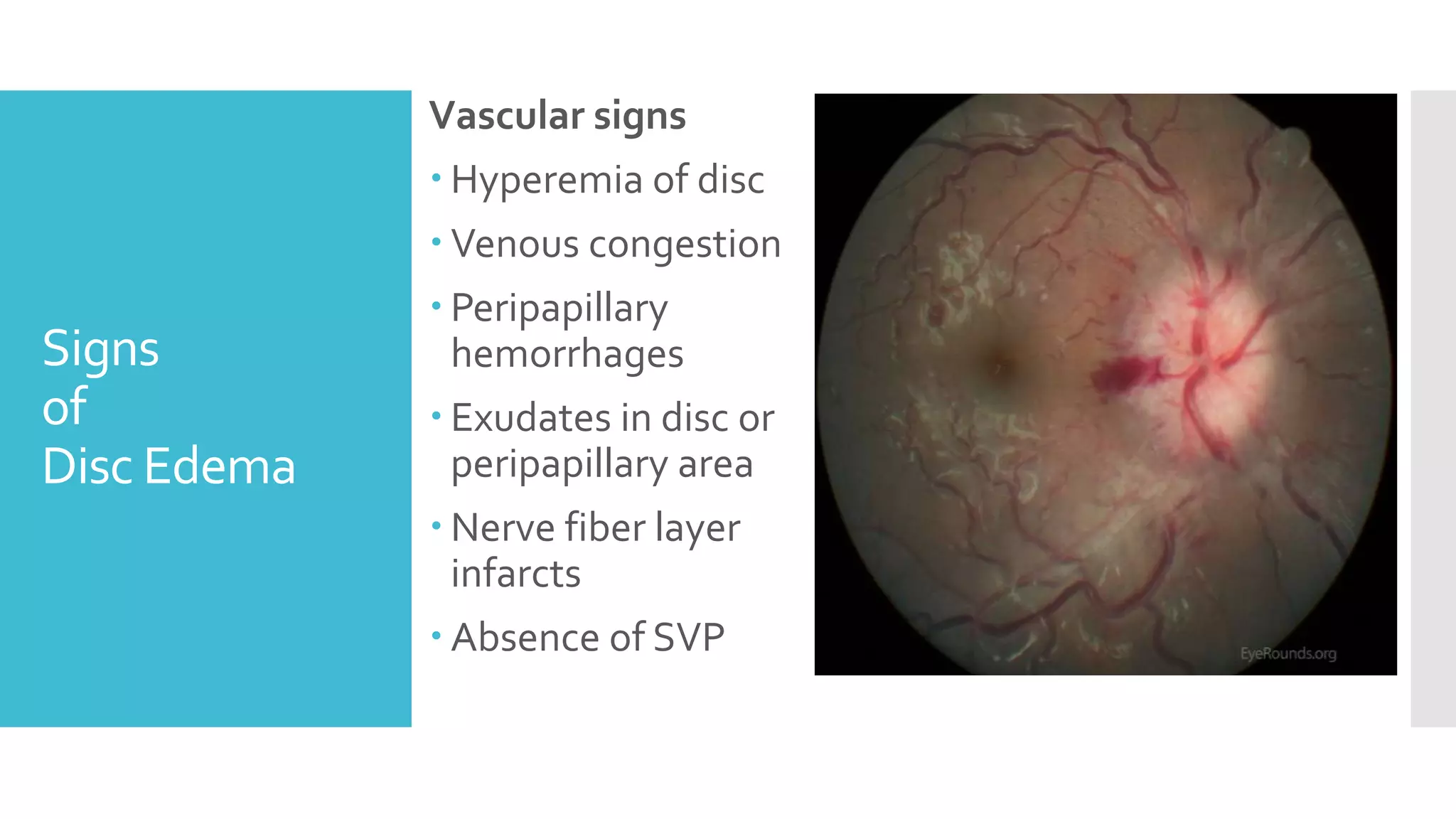 Differential Diagnosis of Disc Edema | PPTX
