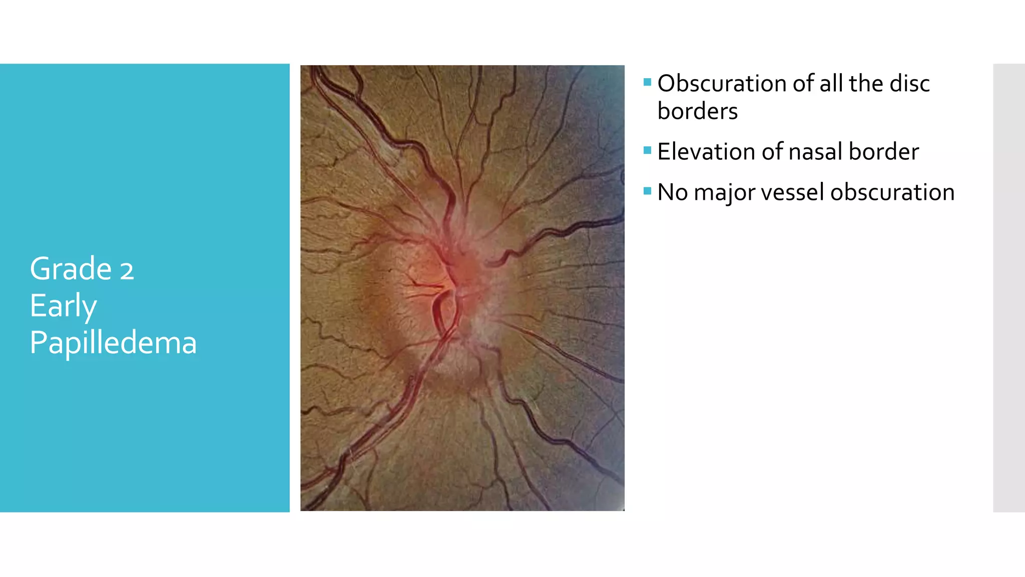 Differential Diagnosis of Disc Edema | PPTX