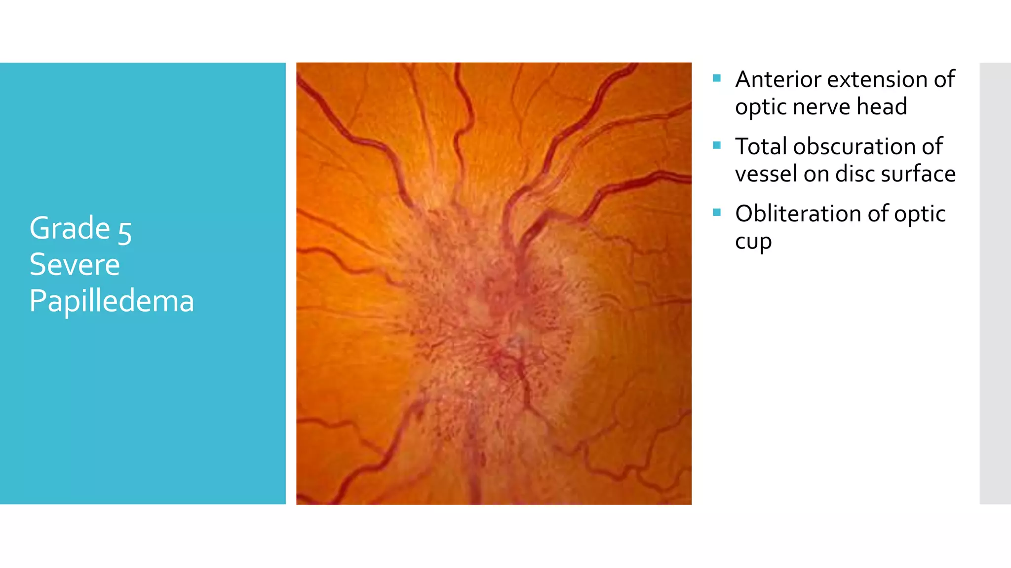Differential Diagnosis of Disc Edema | PPTX