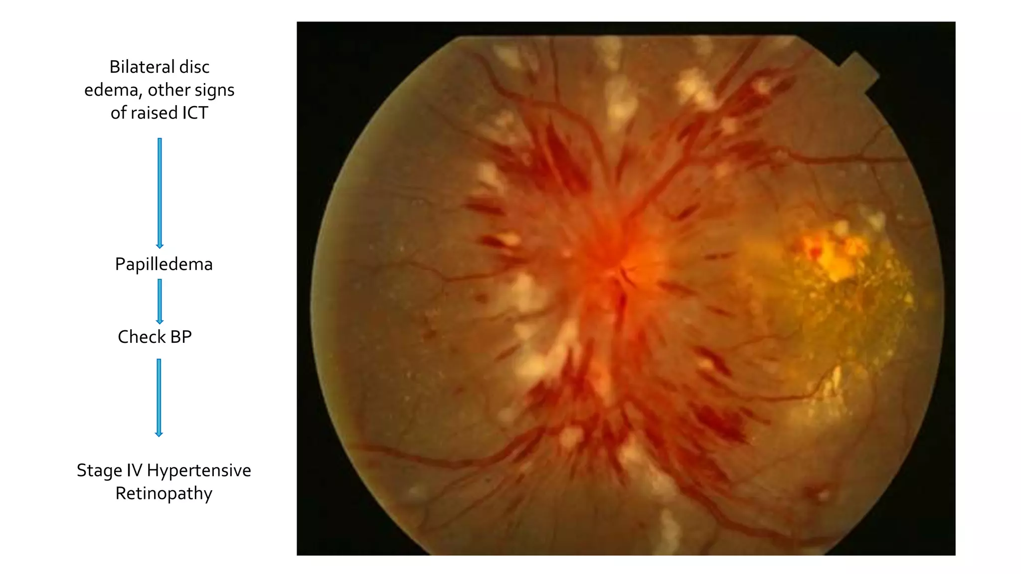 Differential Diagnosis of Disc Edema | PPTX