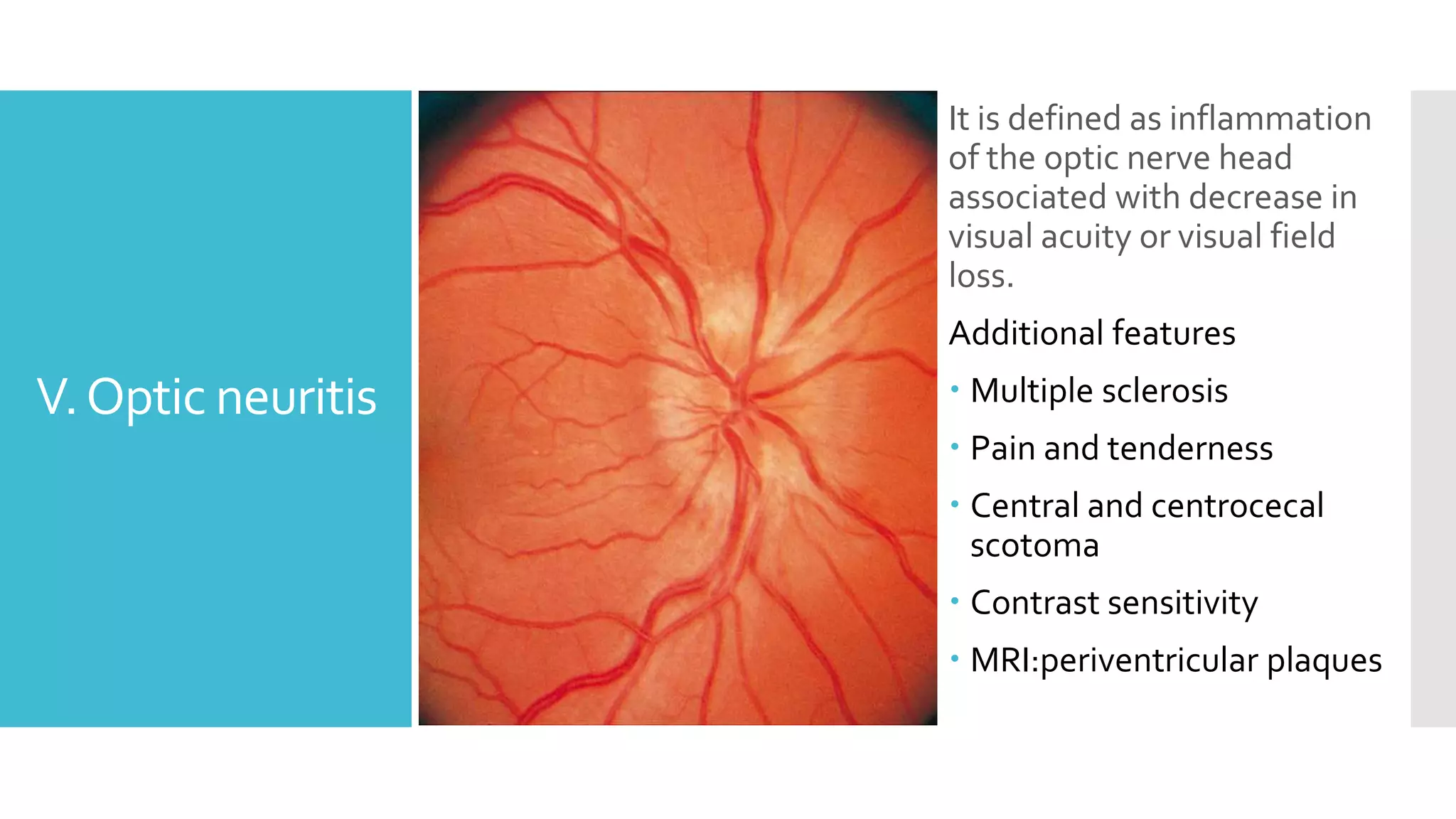Differential Diagnosis of Disc Edema | PPTX | Eye and Vision Conditions ...