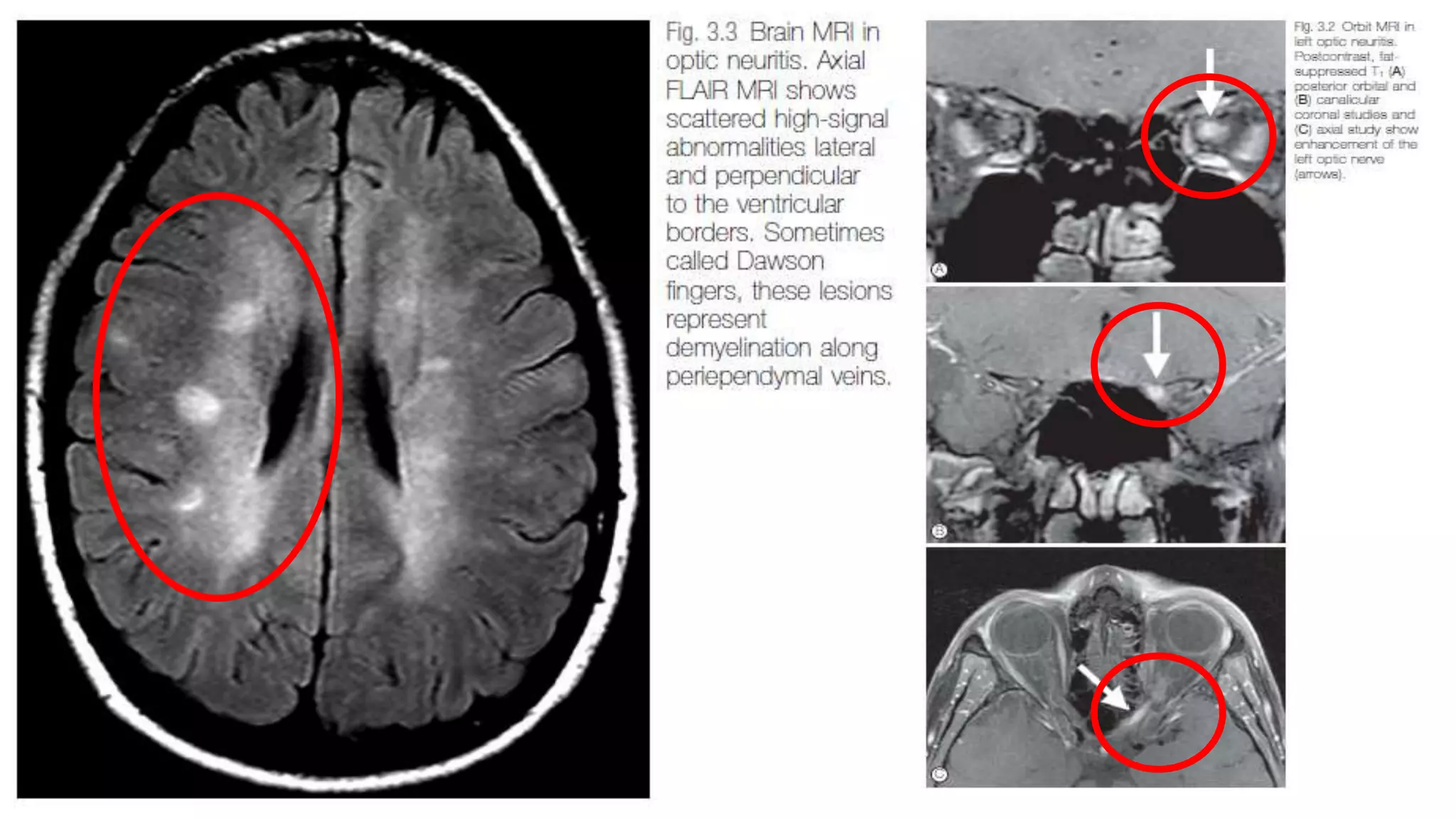Differential Diagnosis of Disc Edema | PPTX