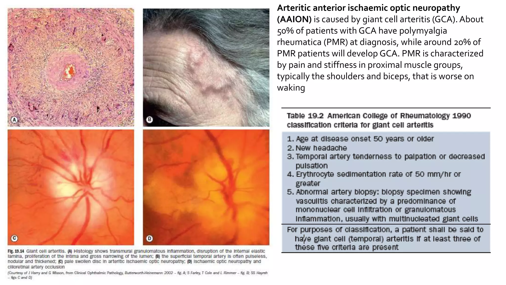 Differential Diagnosis of Disc Edema | PPTX