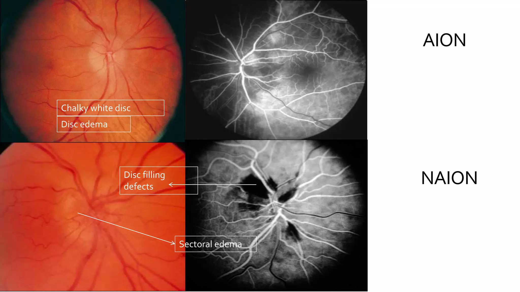 Differential Diagnosis of Disc Edema | PPTX | Eye and Vision Conditions ...