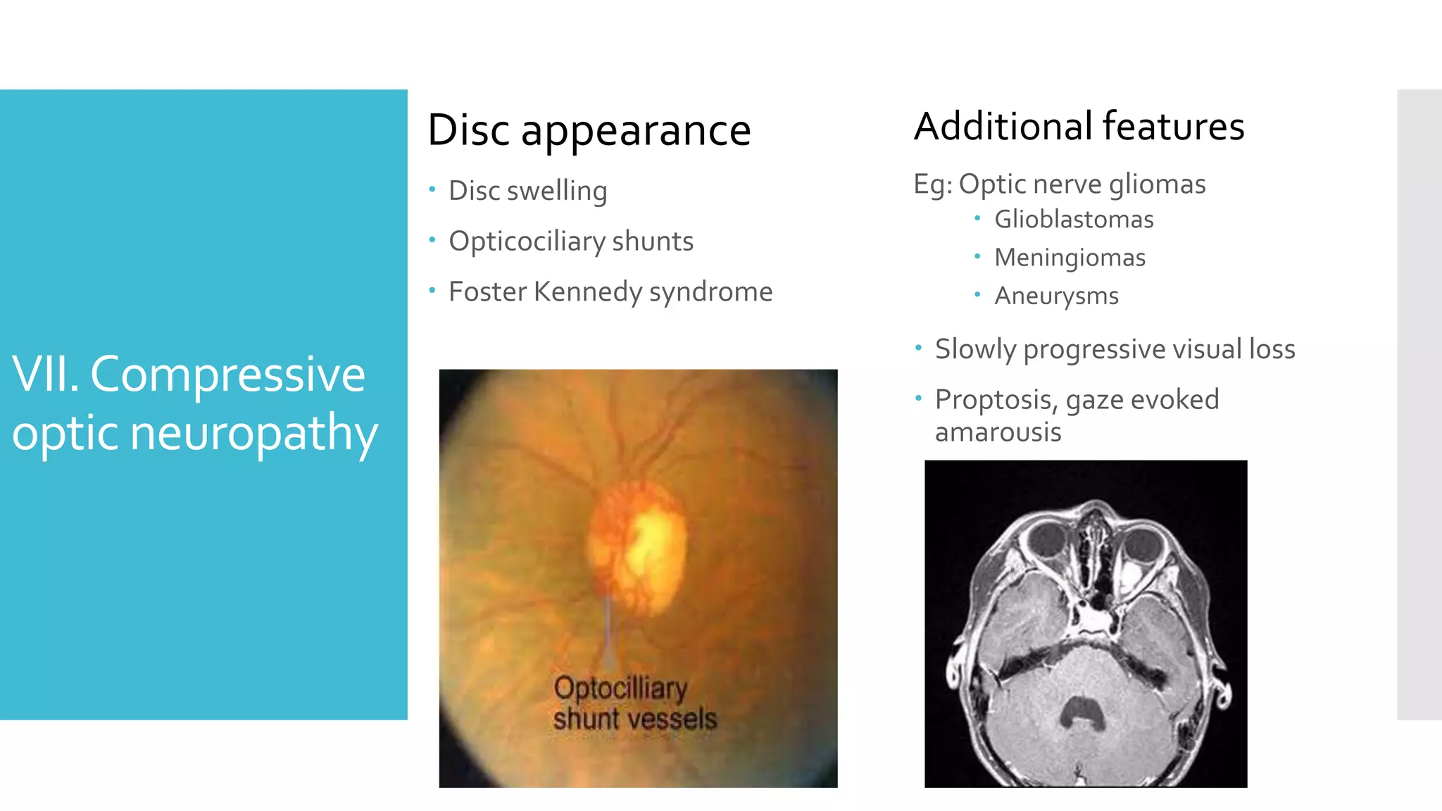 Differential Diagnosis of Disc Edema | PPTX