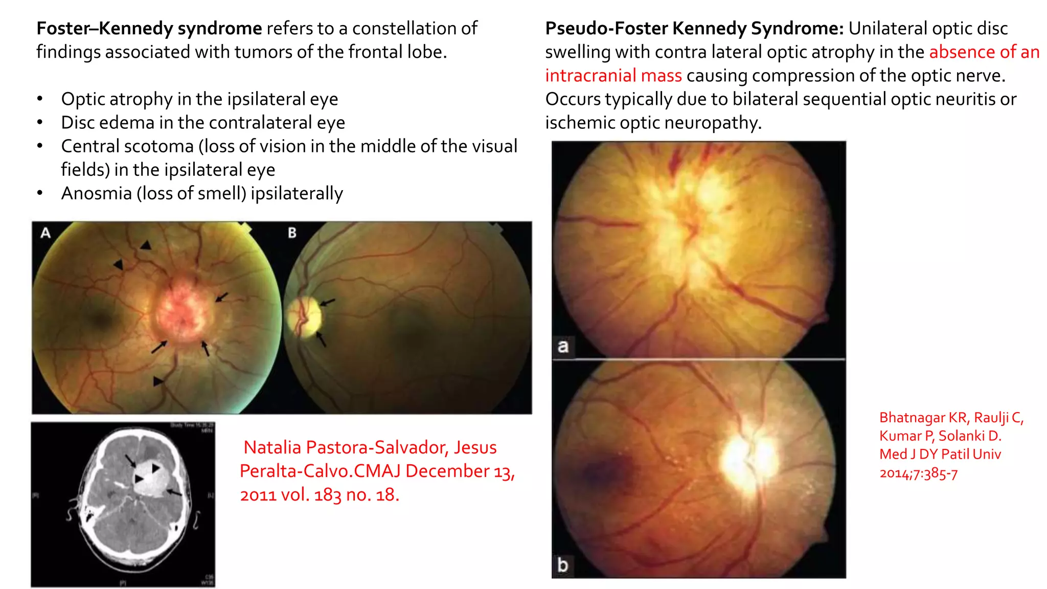 Differential Diagnosis of Disc Edema | PPTX
