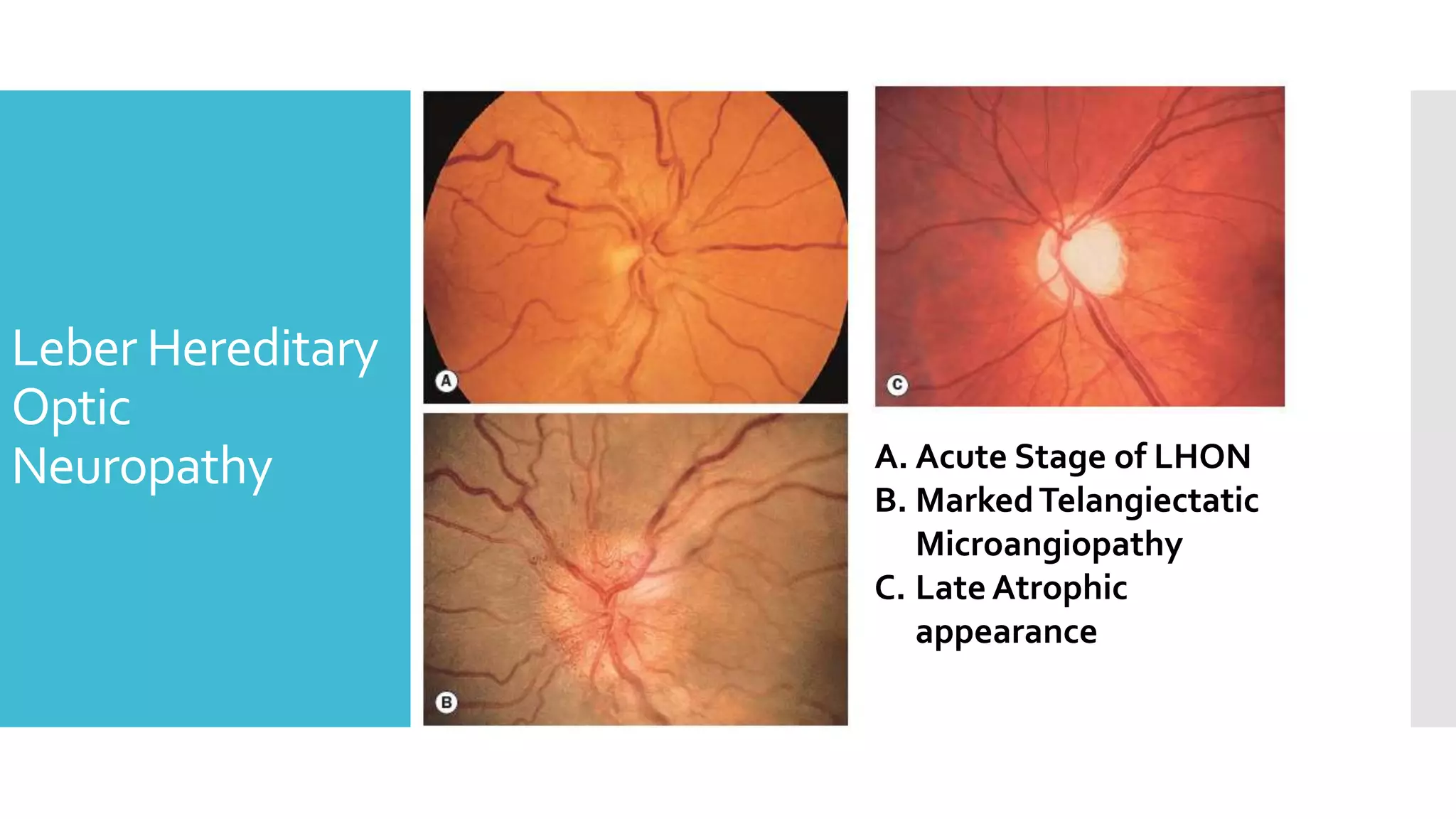 Differential Diagnosis of Disc Edema | PPTX