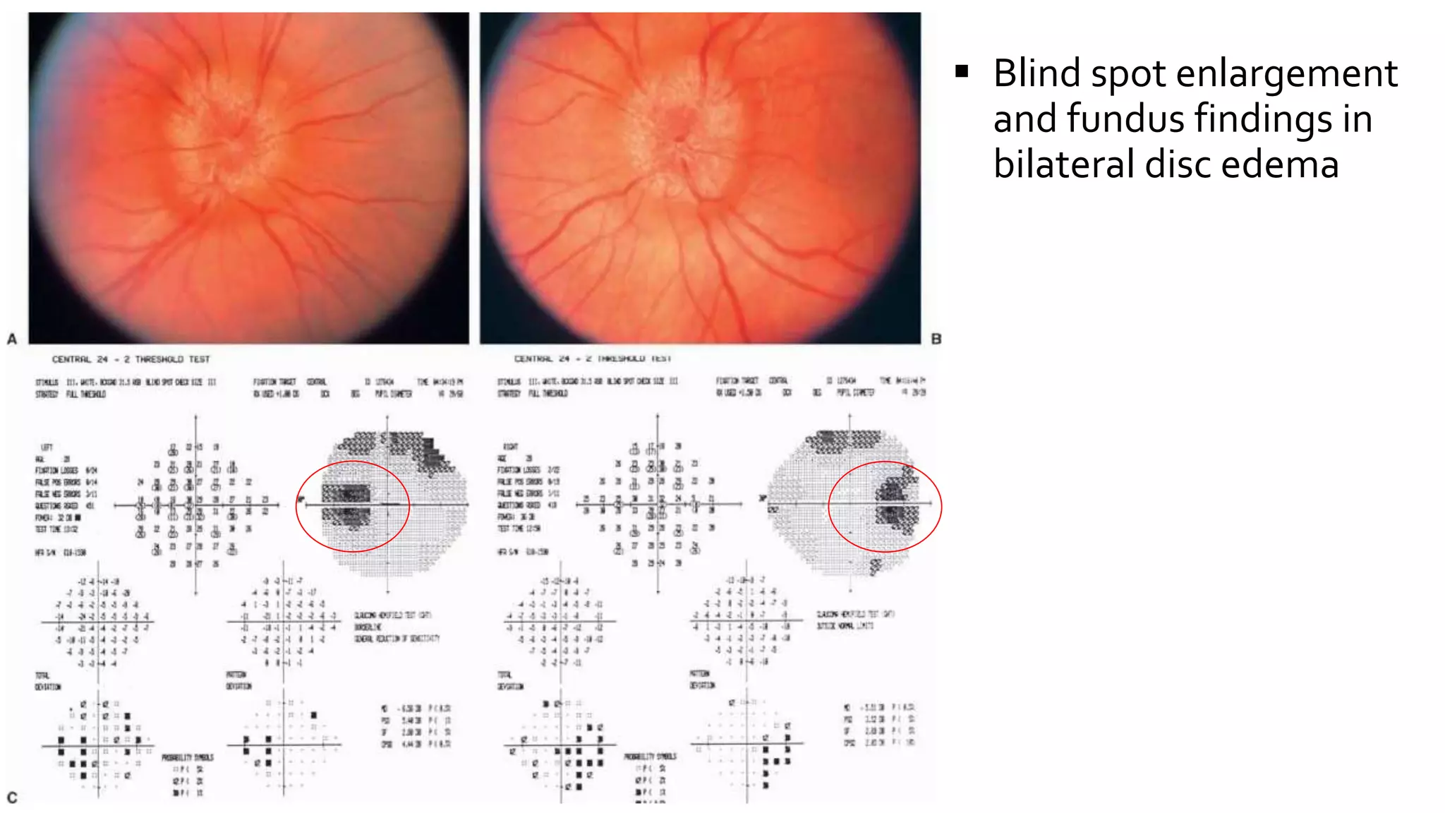 Differential Diagnosis of Disc Edema | PPTX