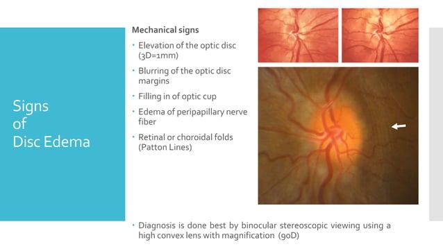 Differential Diagnosis of Disc Edema | PPTX | Eye and Vision Conditions ...