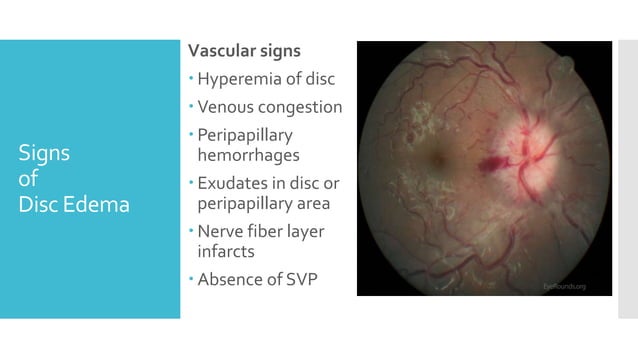 Differential Diagnosis of Disc Edema | PPTX | Eye and Vision Conditions ...