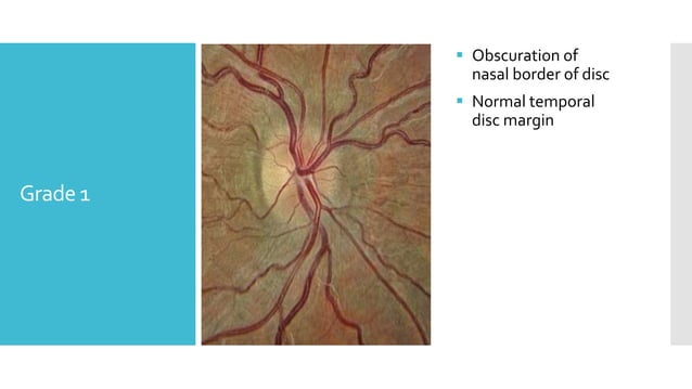 Differential Diagnosis of Disc Edema | PPTX | Eye and Vision Conditions ...