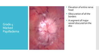 Differential Diagnosis of Disc Edema | PPTX