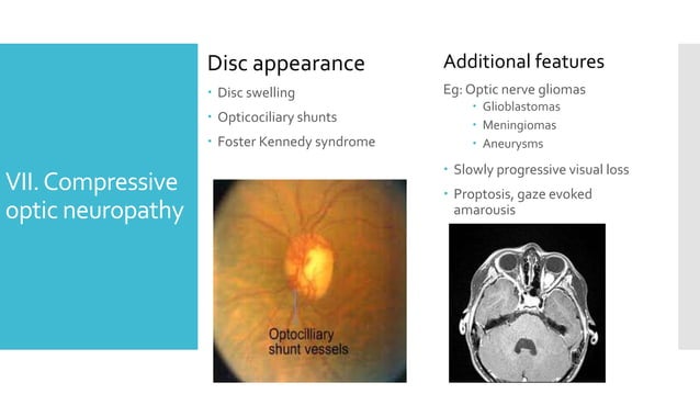 Differential Diagnosis of Disc Edema | PPTX | Eye and Vision Conditions ...