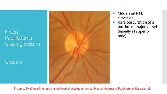 Differential Diagnosis of Disc Edema | PPT