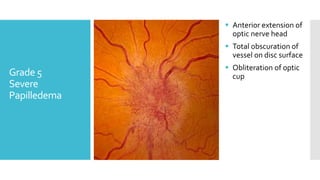 Optic Disc Edema
