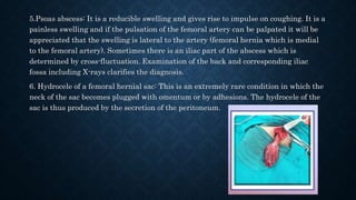 differential diagnosis of femoral hernia-Bhadra.pptx