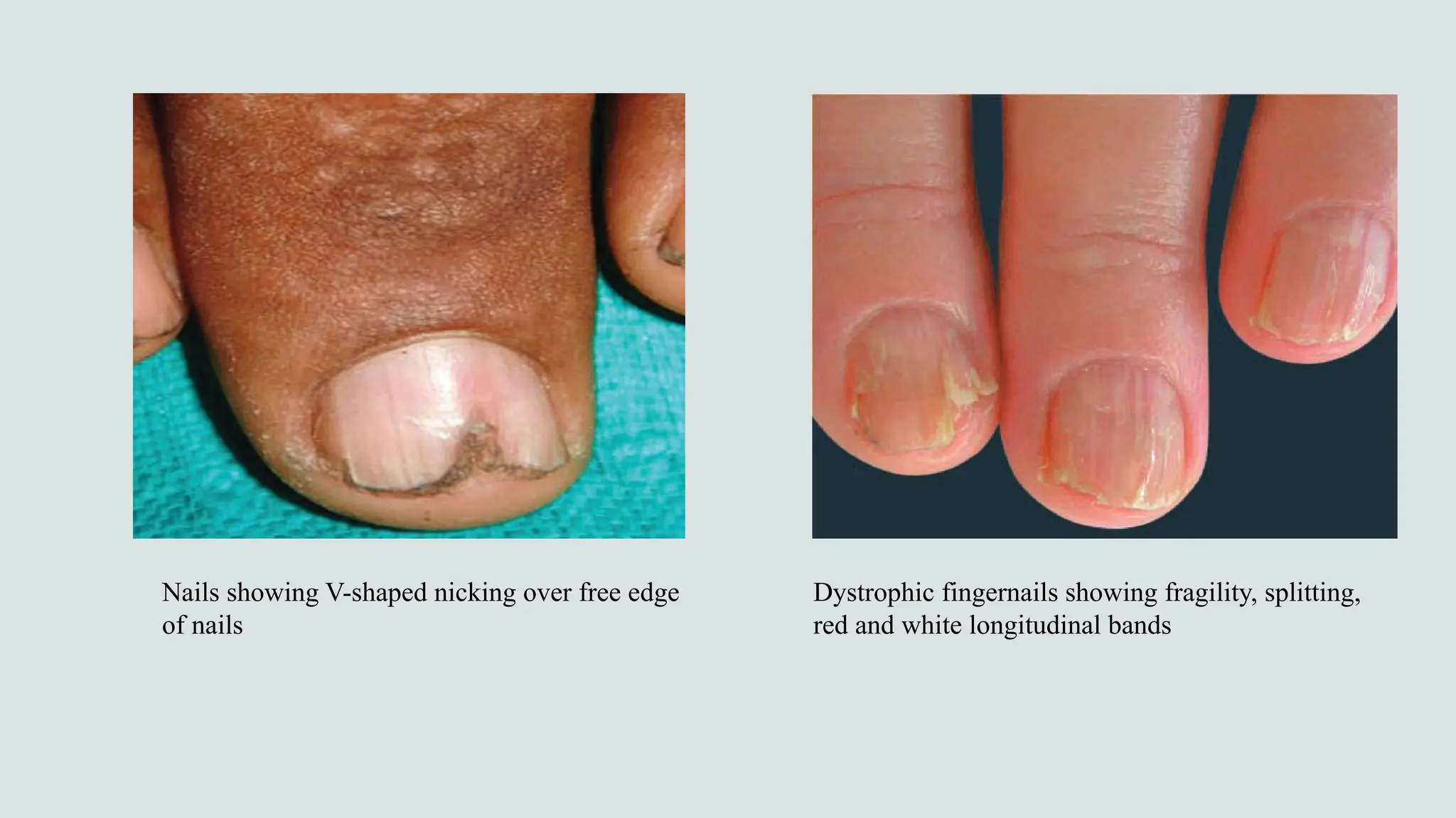 Differential diagnosis of keratosis follicularis.pptx