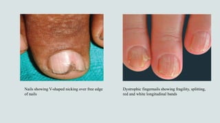 Differential diagnosis of keratosis follicularis.pptx