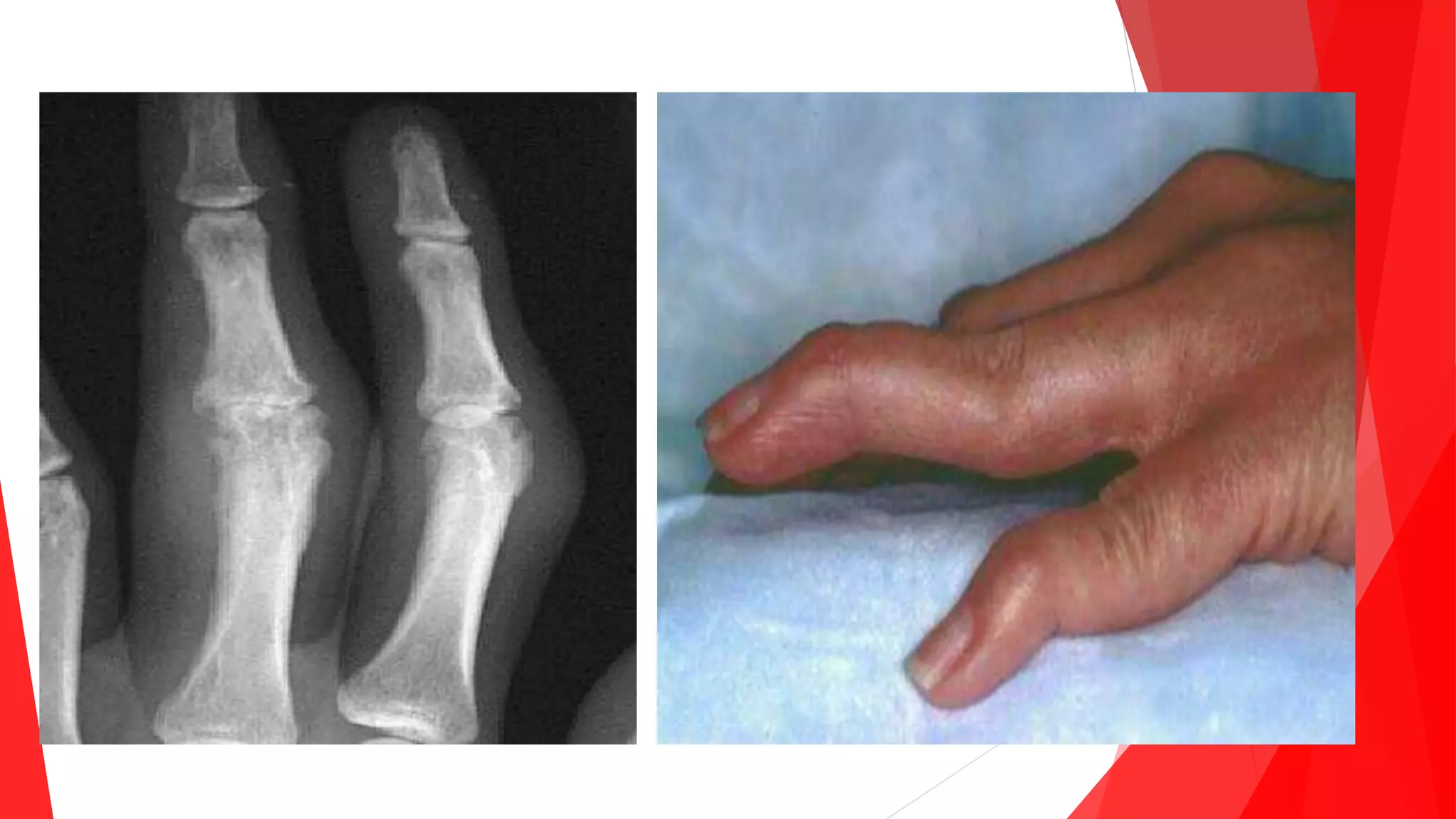 Differential diagnosis of musculoskeletal involvement in rheumatoid ...