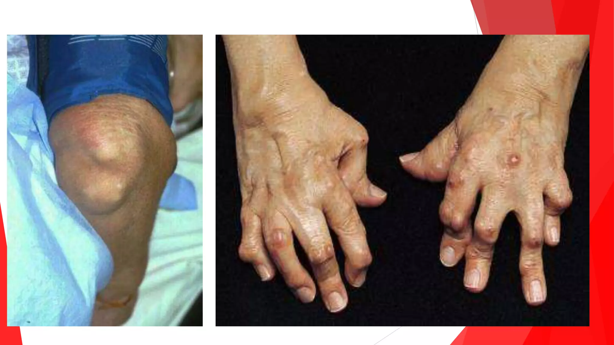 Differential diagnosis of musculoskeletal involvement in rheumatoid ...