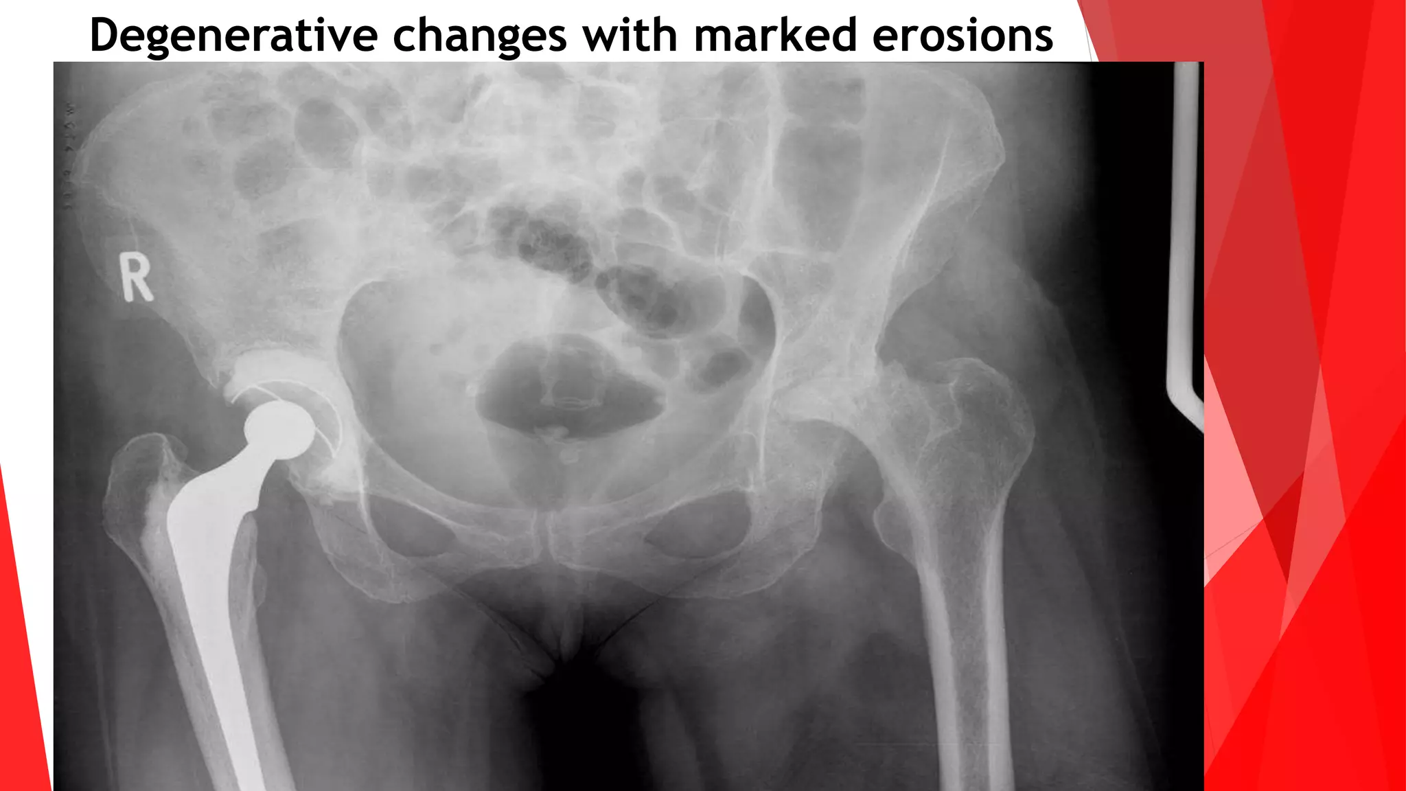 Differential diagnosis of musculoskeletal involvement in rheumatoid ...