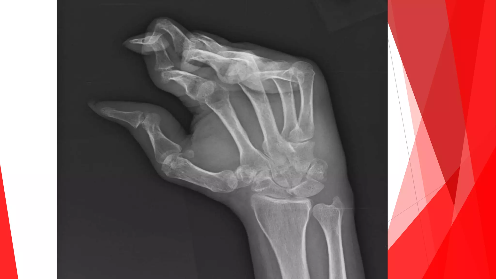 Differential diagnosis of musculoskeletal involvement in rheumatoid ...