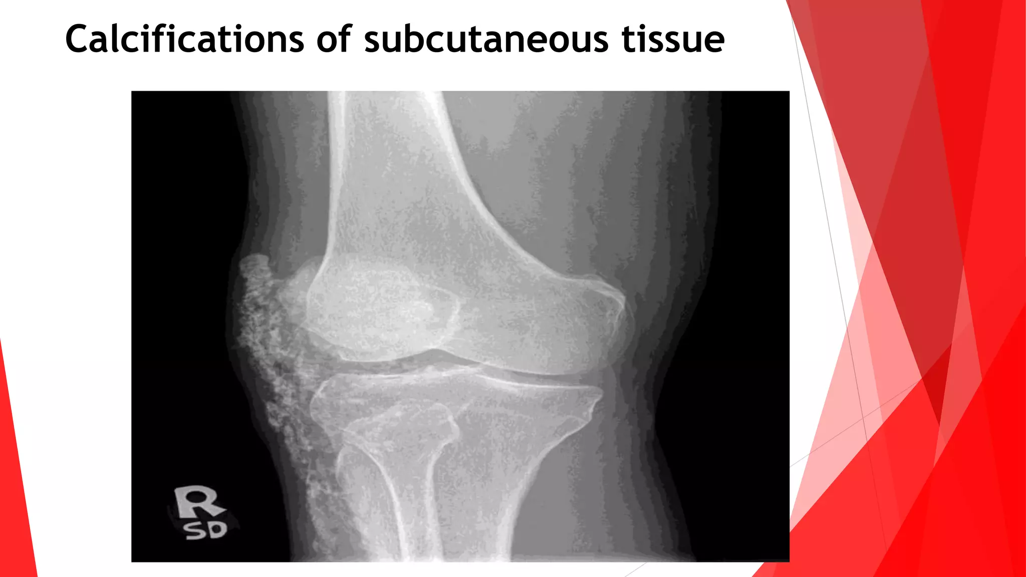 Differential diagnosis of musculoskeletal involvement in rheumatoid ...