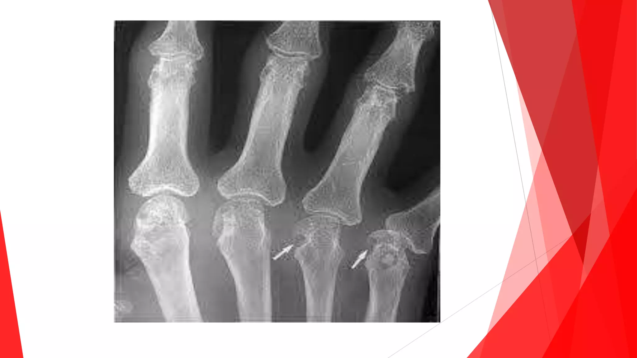 Differential diagnosis of musculoskeletal involvement in rheumatoid ...