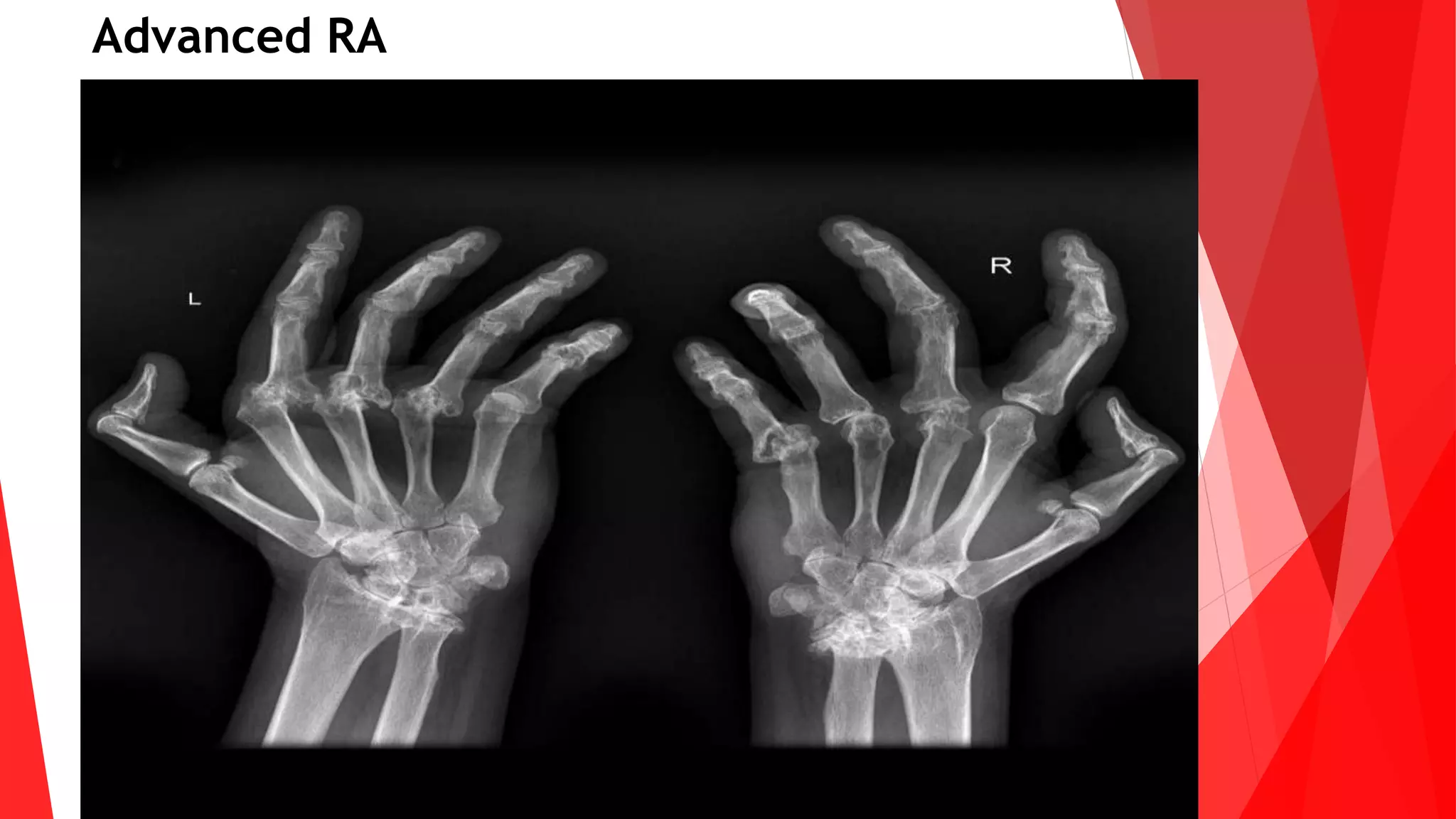 Differential diagnosis of musculoskeletal involvement in rheumatoid ...