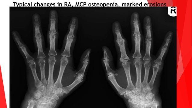 Differential diagnosis of musculoskeletal involvement in rheumatoid ...