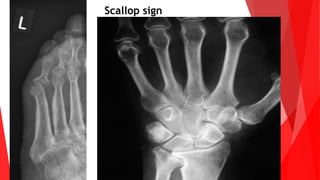 Differential diagnosis of musculoskeletal involvement in rheumatoid ...