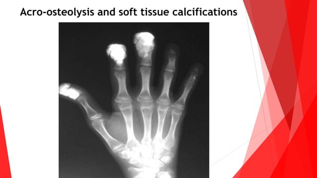 Differential diagnosis of musculoskeletal involvement in rheumatoid ...