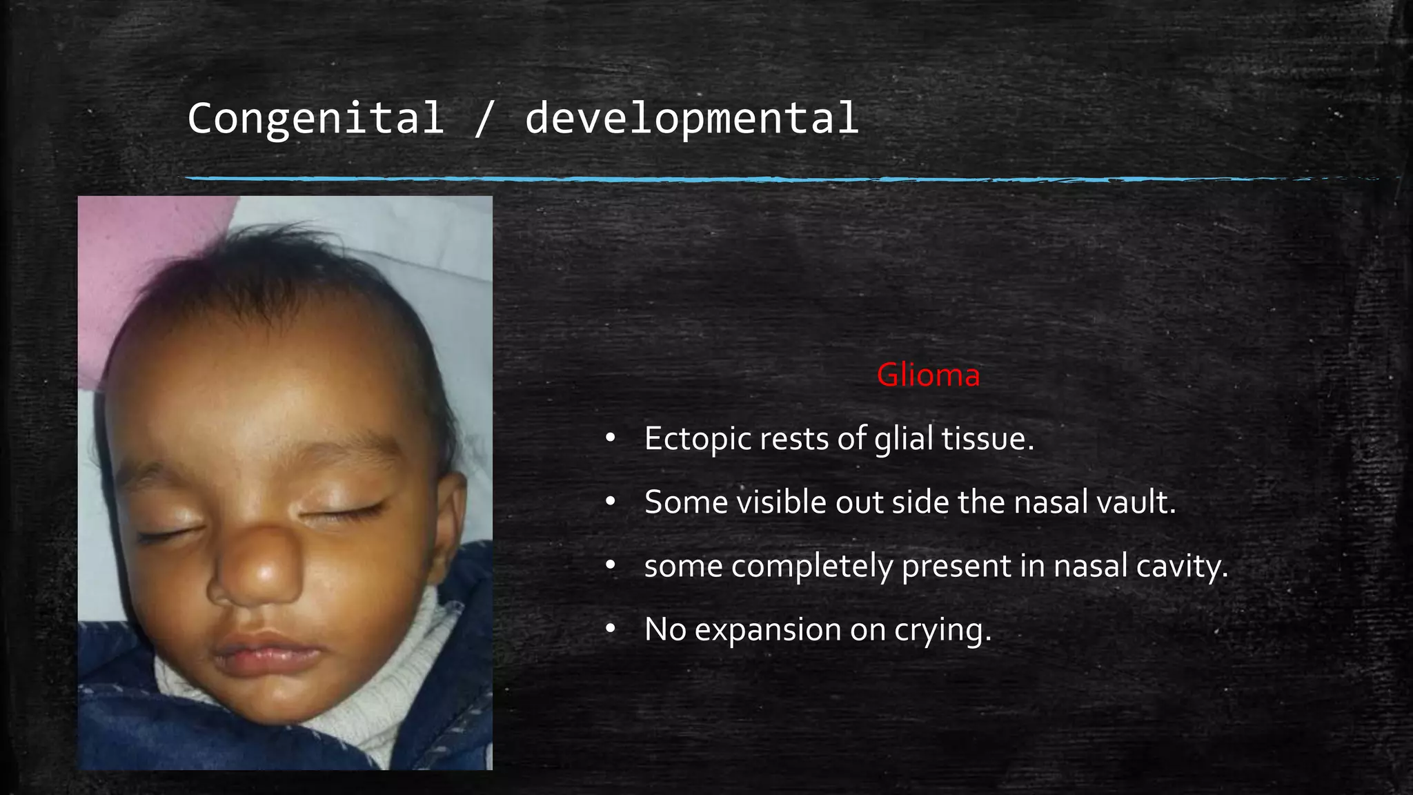 Differential diagnosis of nasal mass | PPTX