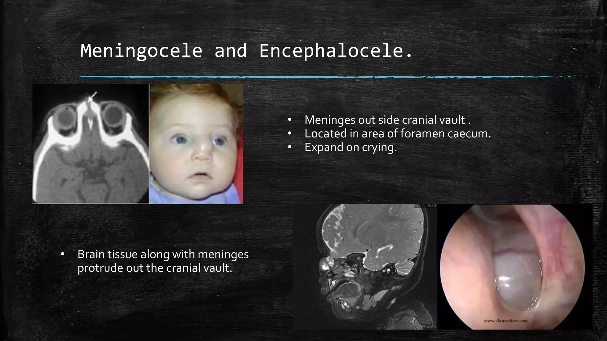 Differential diagnosis of nasal mass | PPTX