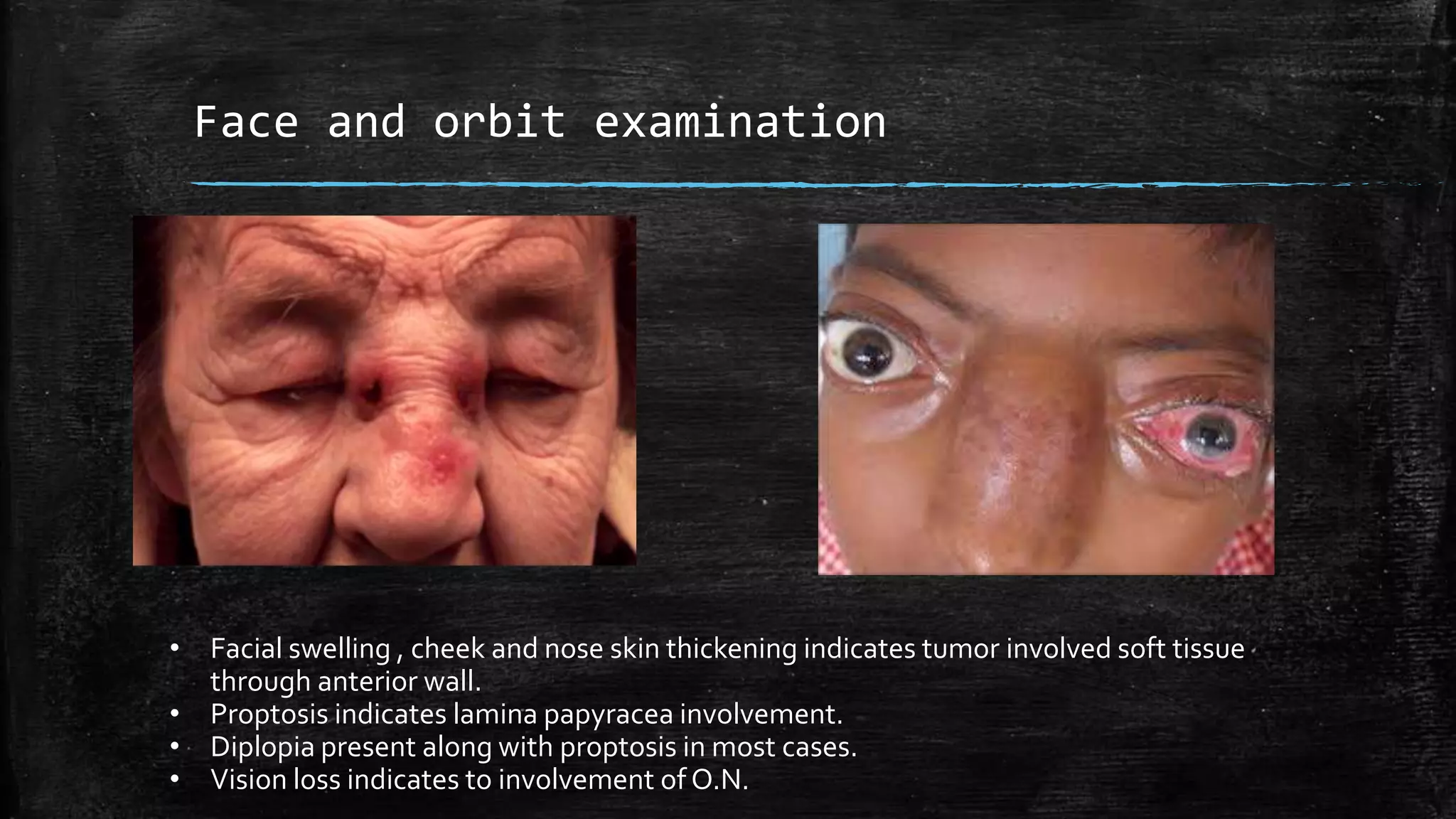 Differential diagnosis of nasal mass | PPTX