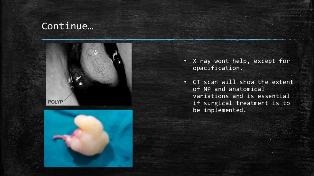 Differential Diagnosis Of Nasal Mass