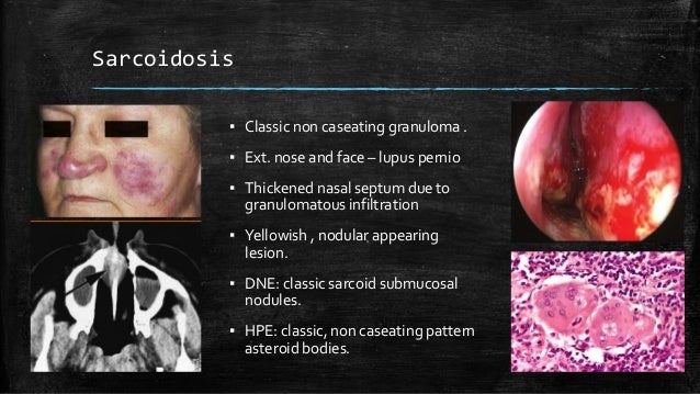 Differential diagnosis of nasal mass