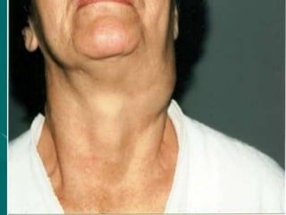 Differential diagnosis of neck mass.ppt