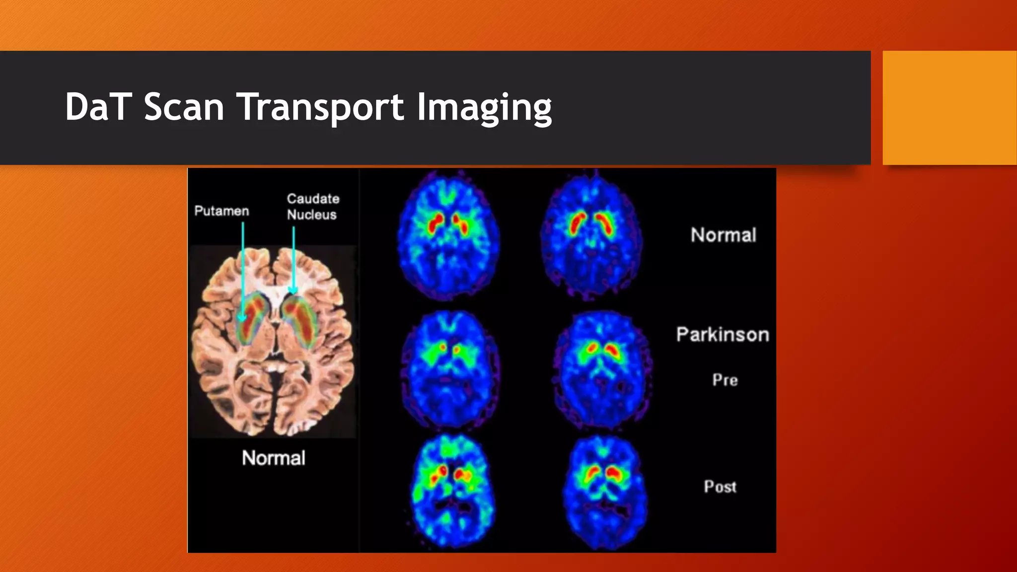 Differential diagnosis of parkinson's disease | PPTX