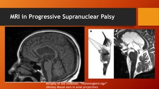 Differential diagnosis of parkinson's disease | PPTX