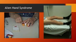 Differential diagnosis of parkinson's disease | PPTX